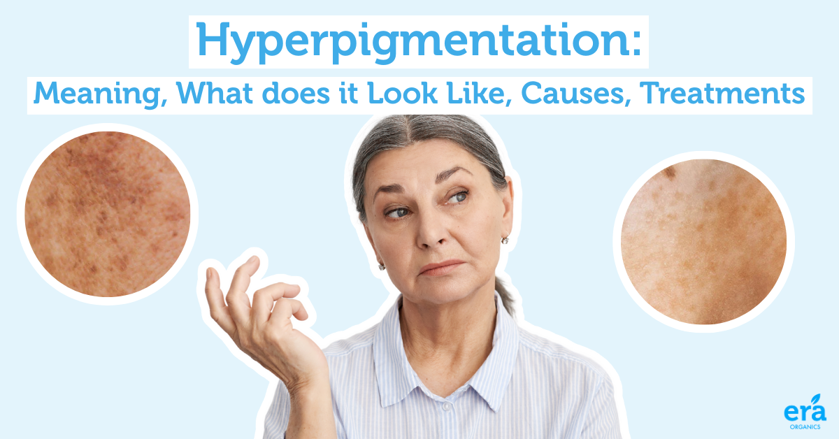 Hyperpigmentation: Meaning, Causes, Treatments – Era Organics